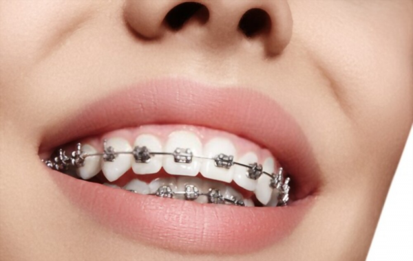 Orthodontics - Braces and Clear Aligners - Al Bahri Dental and ...