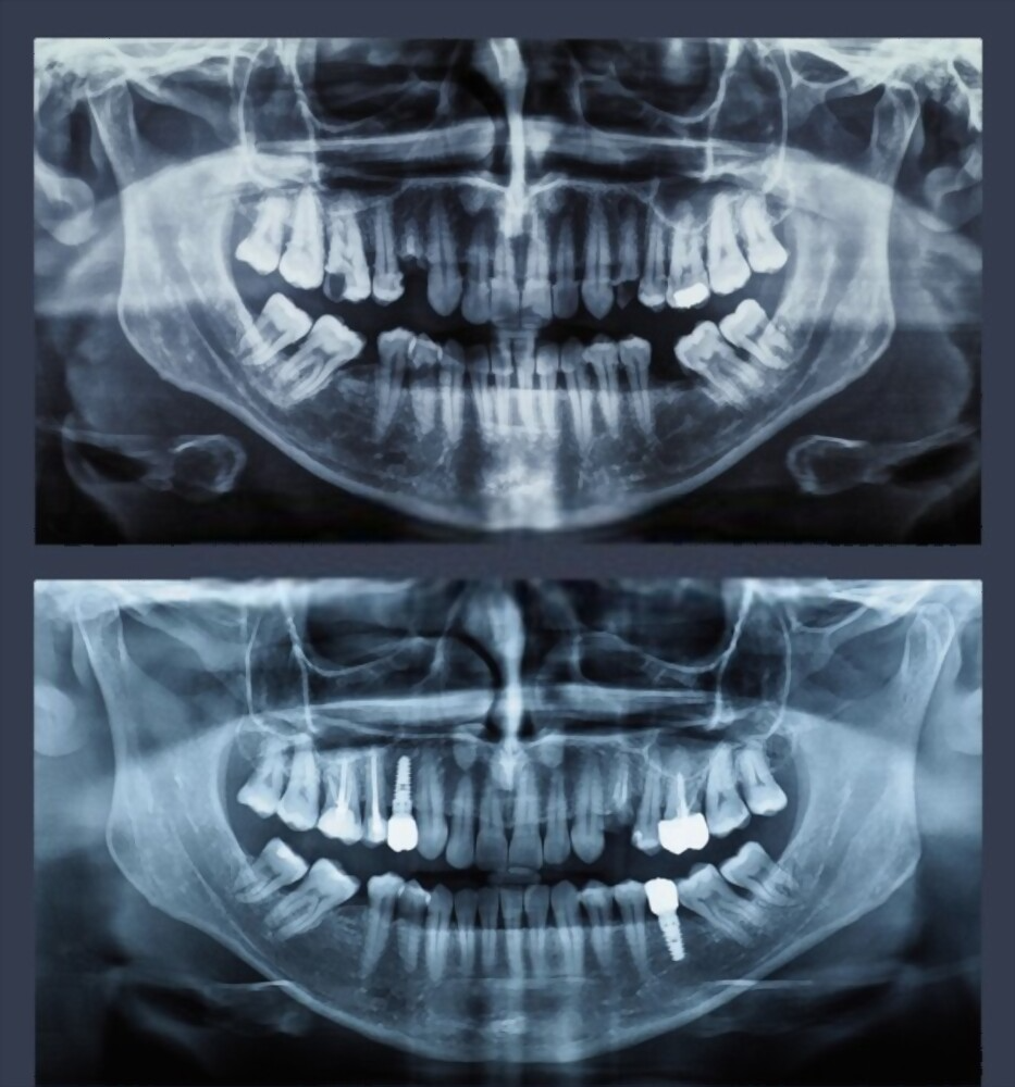 What are Dental Implants? - Al Bahri Dental and Orthodontic Center
